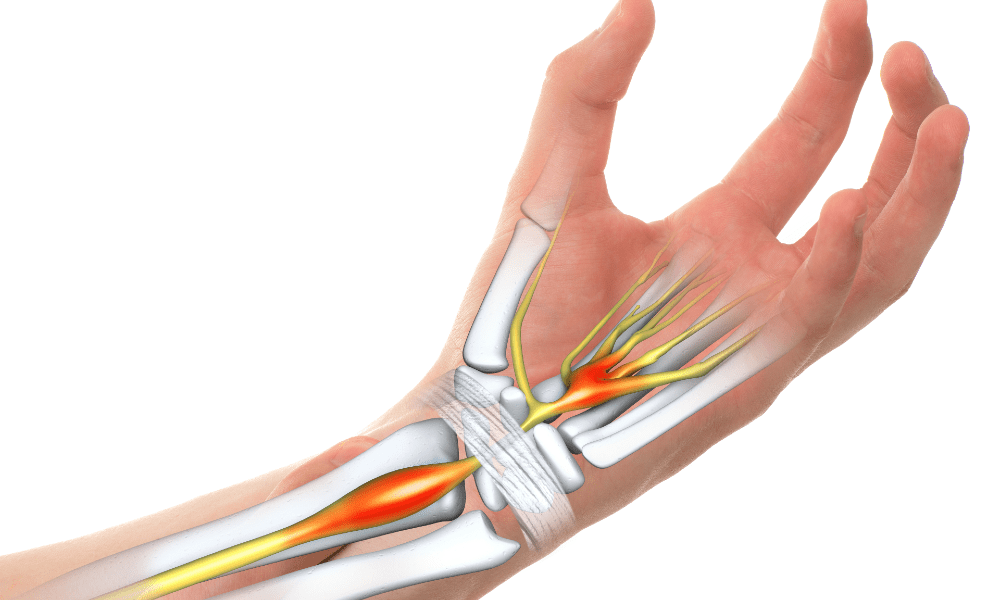 Strategies To Prevent Carpal Tunnel Syndrome Prime Health Reports
